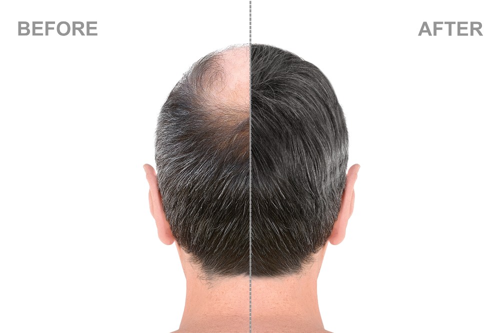 Bookmedi – Biofibre Hair Transplants