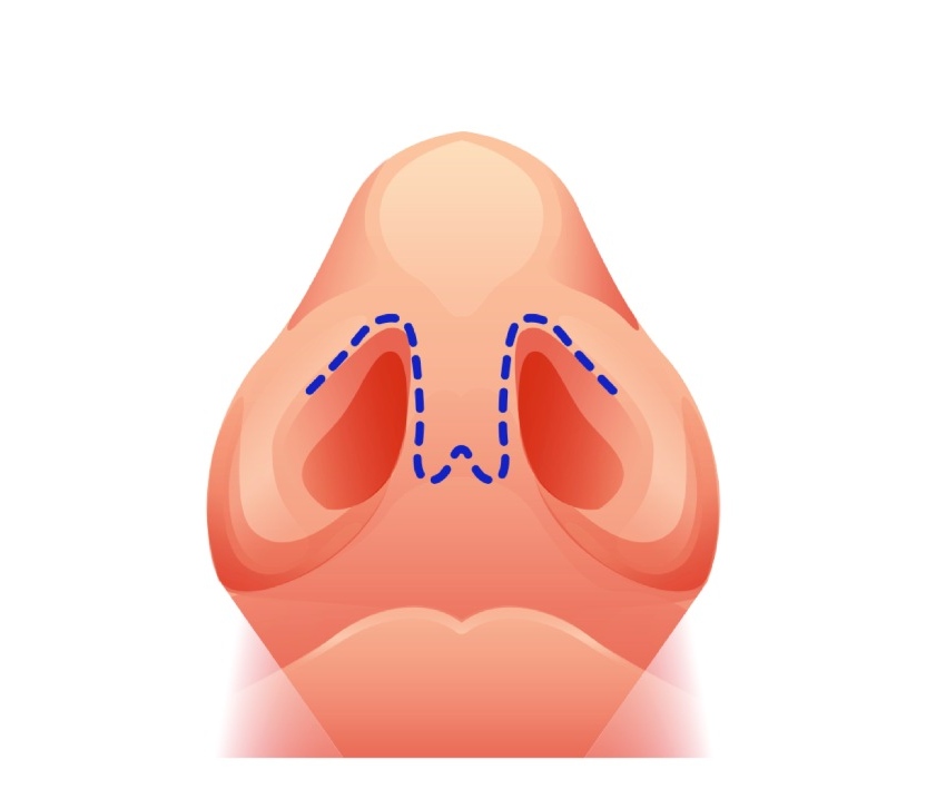 Rhinoplasty in Turkey - Bookmedi